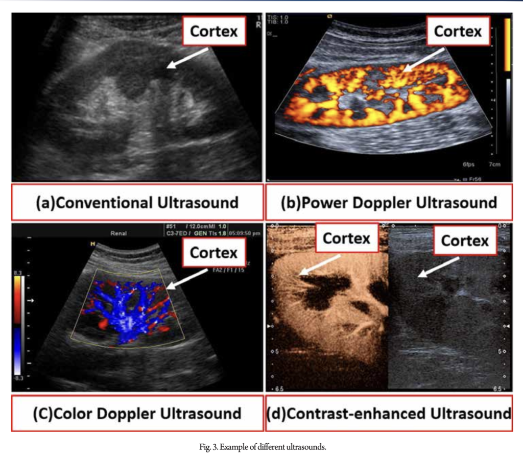 Non-Invasive Techniques for Early Renal Rejection | Conquest Health