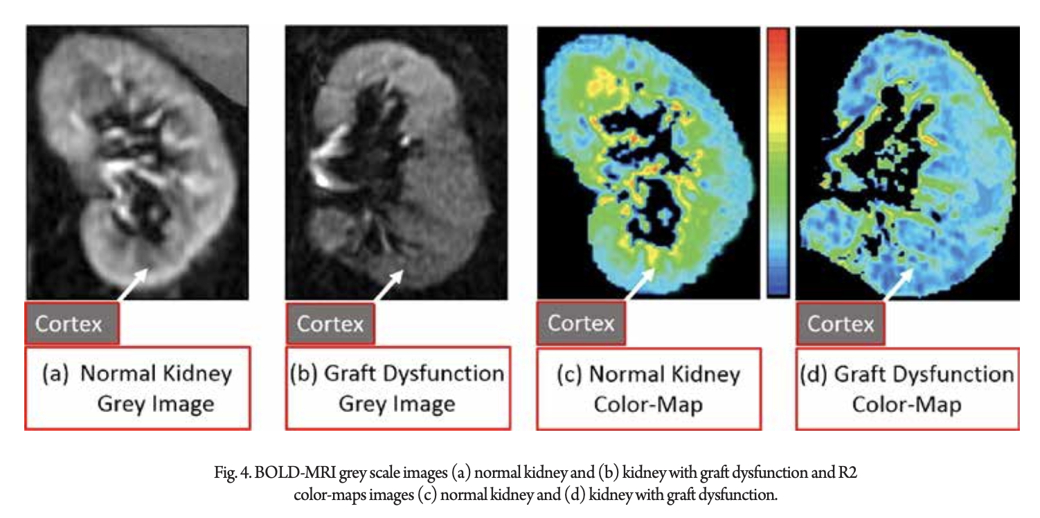 Non-Invasive Techniques for Early Renal Rejection | Conquest Health